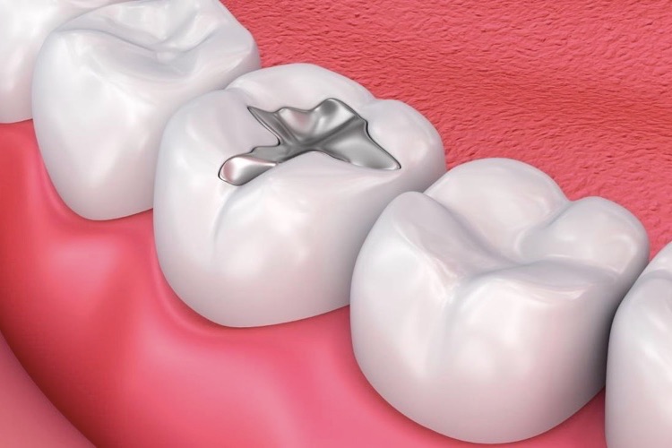 Tooth Fillings • All You Need to Know