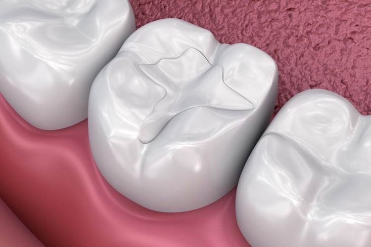 Tooth Fillings • All You Need to Know