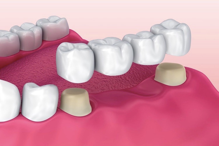 Dental Bridges • All You Need to Know