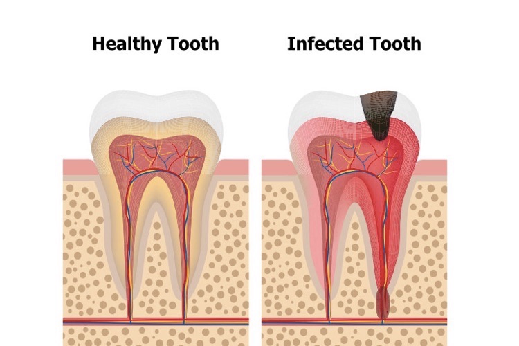 Root Canal Treatment • All You Need to Know