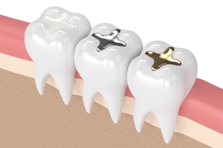 Tooth Fillings • All You Need to Know