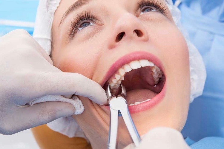 How to Relieve Pain After Tooth Extraction
