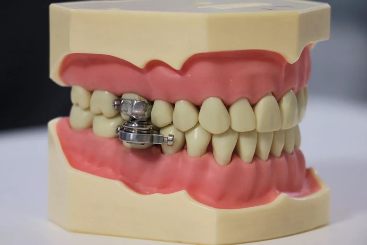 The Controversial Practice of Slimming Wires