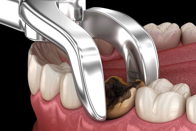 Tooth Extraction • Tooth Removal